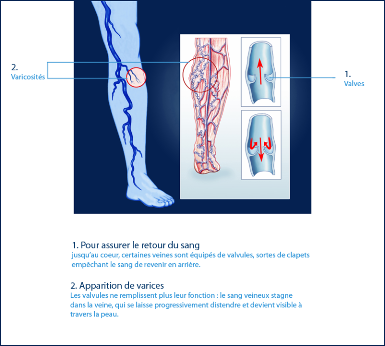 Varicosités des membres inférieurs - Médecine Esthétique - Dr Arbab